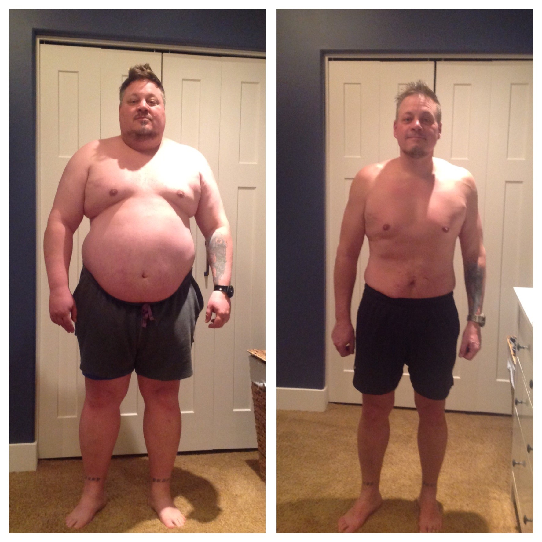 Down 160 lbs with gastric sleeve | SmartShape Weight Loss Centre